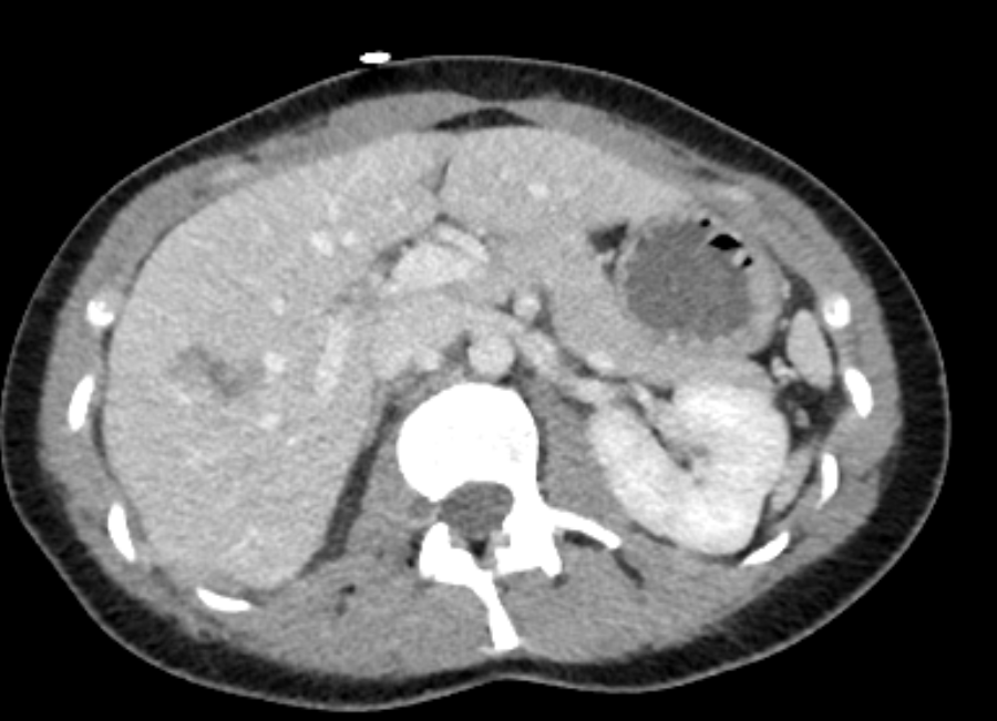 Grade 2 liver injury | Radiology Case | Radshare.net