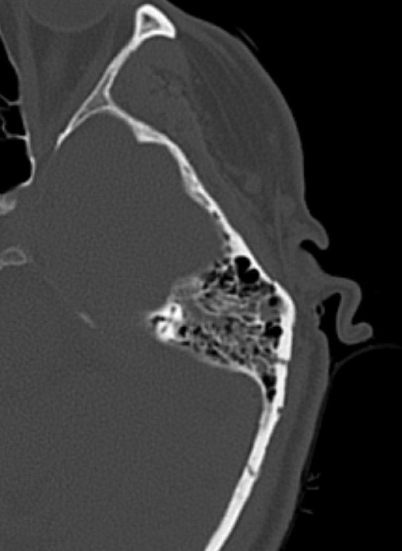 Temporal bone fracture, subarachnoid hemorrhage | Radiology Case ...