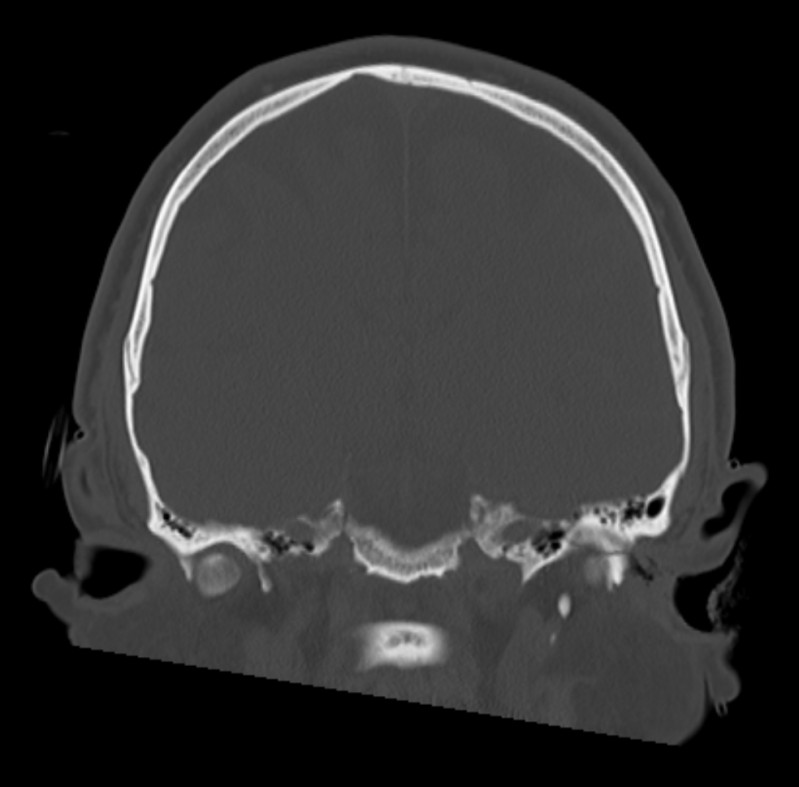 Temporal bone fracture, subarachnoid hemorrhage | Radiology Case ...