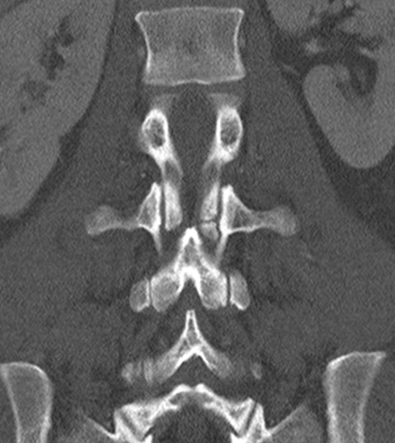 Oppenheimer ossicle | Radiology Case | Radshare.net