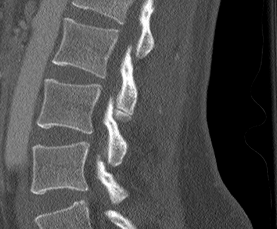 Oppenheimer ossicle | Radiology Case | Radshare.net