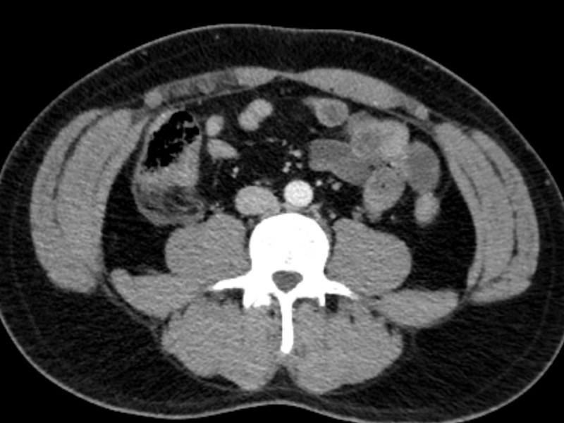 Acute appendicitis | Radiology Case Collection | Radshare.net