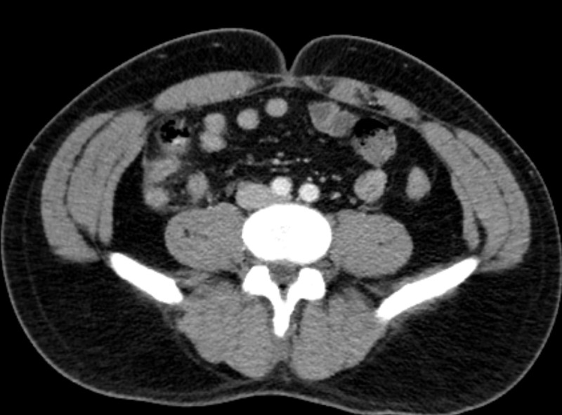 Acute appendicitis | Radiology Case Collection | Radshare.net