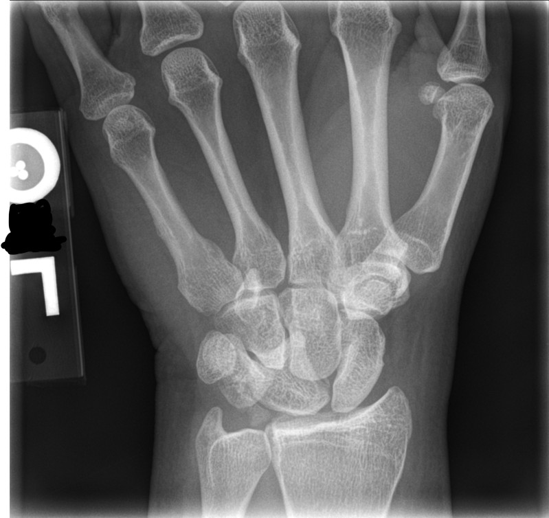 Lunate dislocation | Radiology Case | Radshare.net