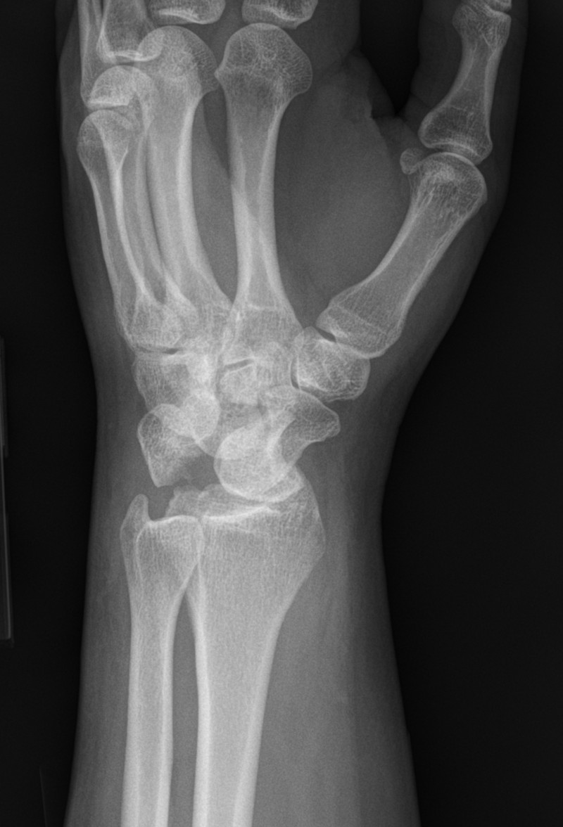 Lunate dislocation | Radiology Case | Radshare.net