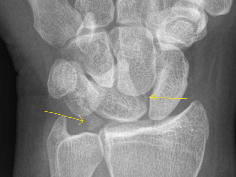 Lunate dislocation | Radiology Case | Radshare.net
