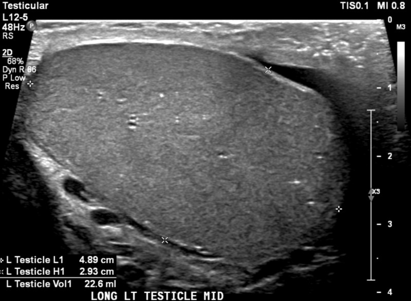 Compensatory testicular hypertrophy | Radiology Case | Radshare.net