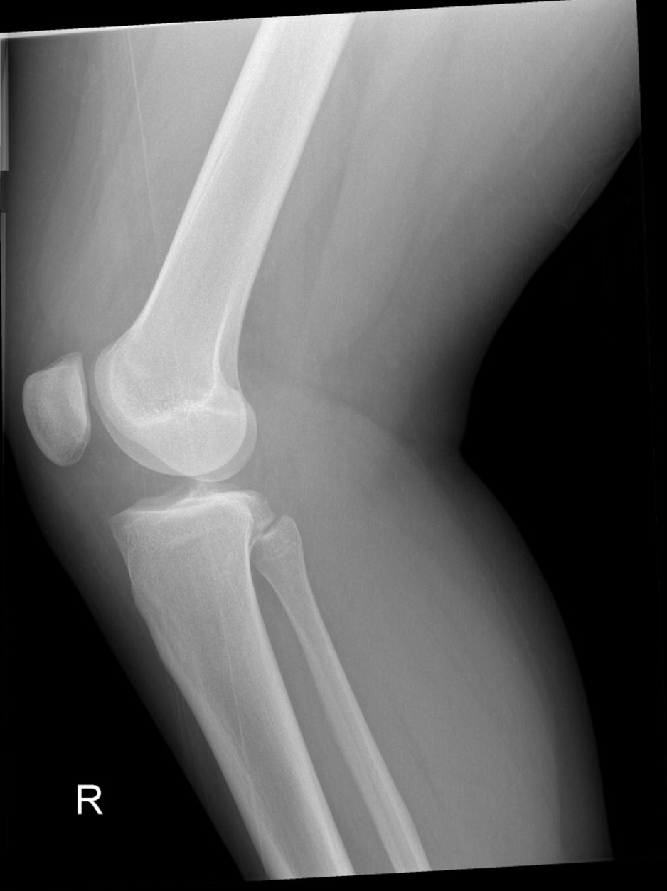 Moderate Knee Joint Effusion | Radiology Case | Radshare.net