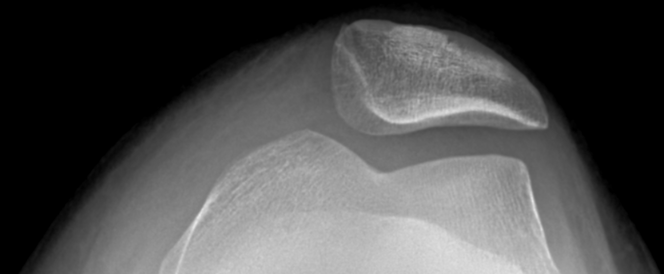 Acute Lateral Patellar Dislocation | Radiology Case | Radshare.net