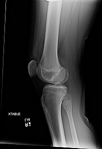 Lateral Patellar Dislocation | Radiology Case | Radshare.net