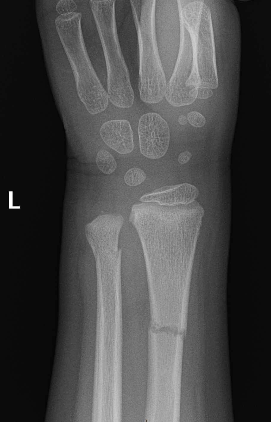 Distal Radius and Ulna Fracture | Radiology Case | Radshare.net